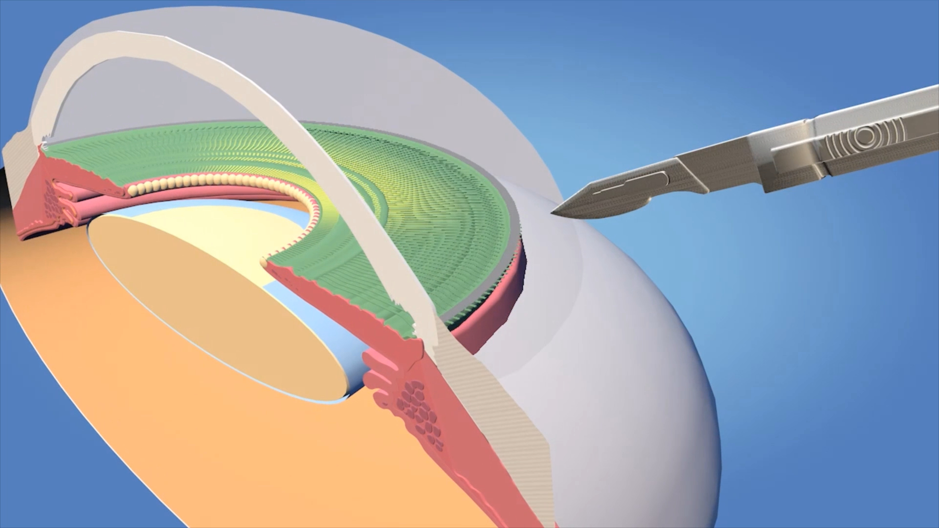 Eye cataract surgery scalpel 3D model - TurboSquid 1196453