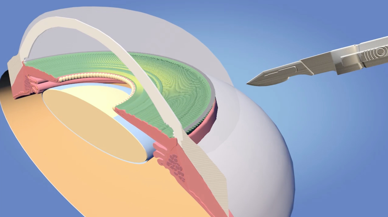 Eye cataract surgery scalpel 3D model - TurboSquid 1196453