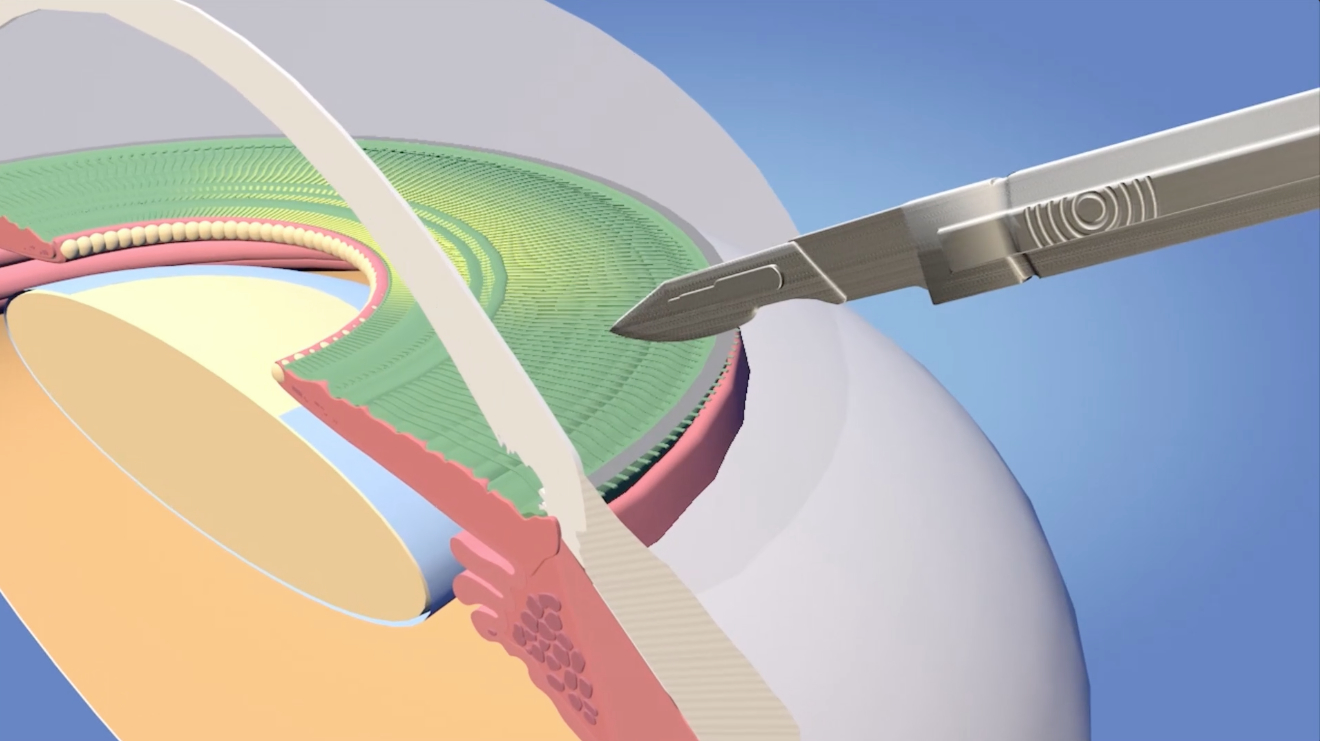 Eye cataract surgery scalpel 3D model - TurboSquid 1196453