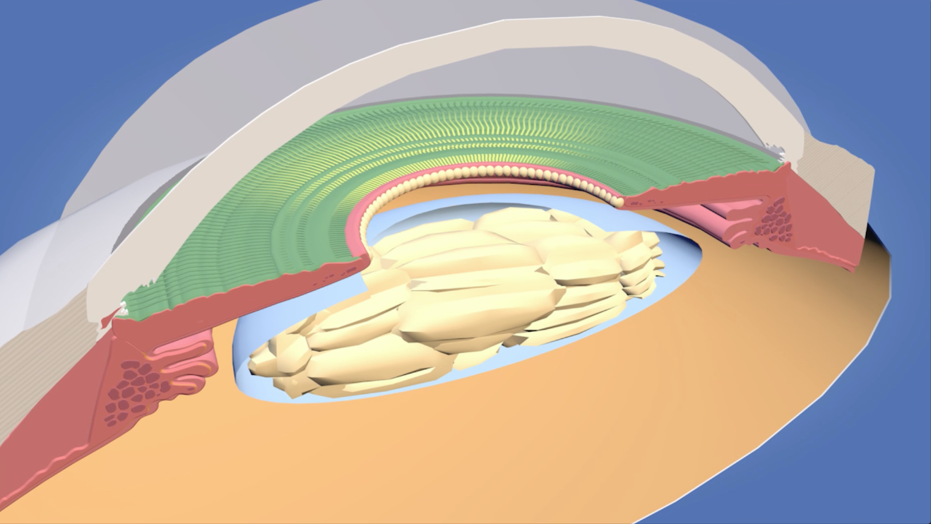 Eye cataract surgery lens model - TurboSquid 1196467