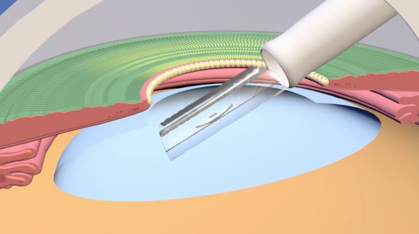Eye cataract surgery lens model - TurboSquid 1196467