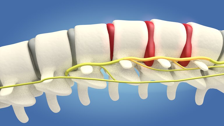 3D spine compression nerve model - TurboSquid 1196483