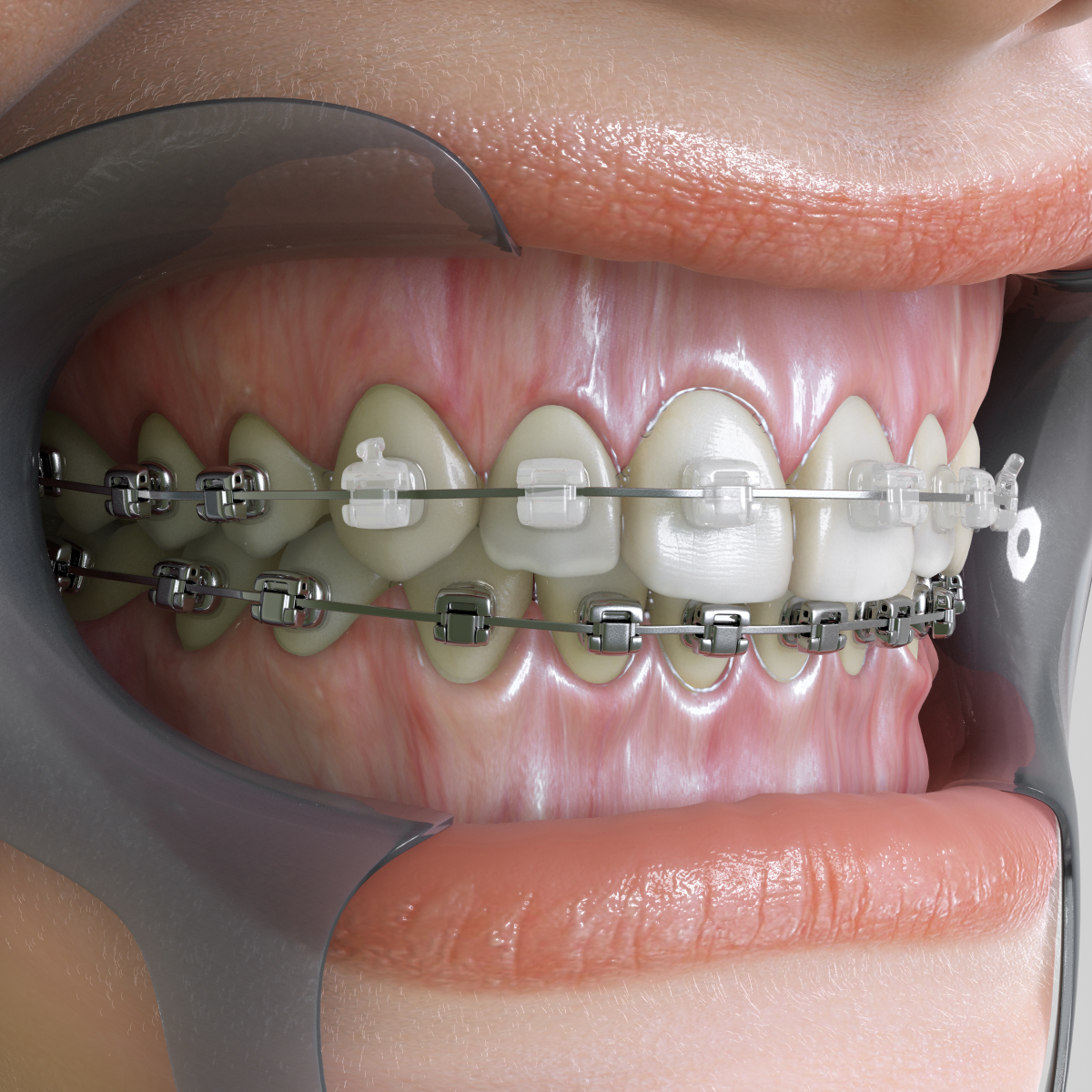 3d female orthodontic teeth face