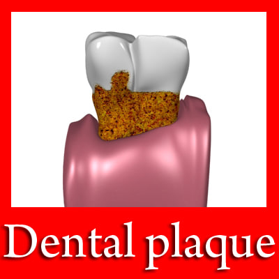 tooth dental plaque 3d model
