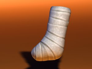 Orthopedic Cast 3D Models for Download | TurboSquid