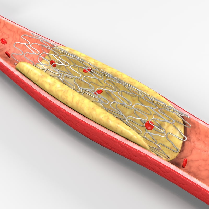 medical cardiovascular stent 3d model