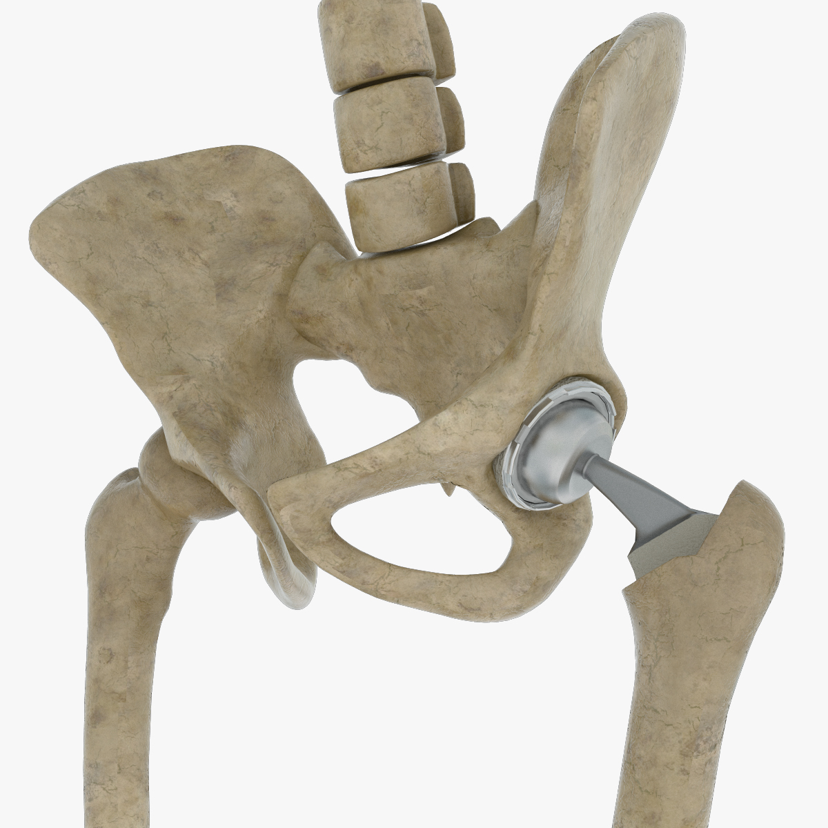 modèle 3D de Prothèse fémorale avec tibia et bassin - TurboSquid 892614