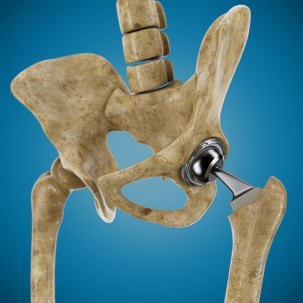 modèle 3D de Prothèse fémorale avec tibia et bassin - TurboSquid 892614