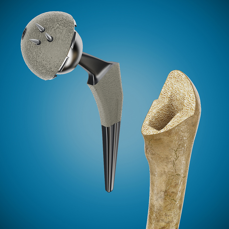modèle 3D de Prothèse fémorale avec tibia et bassin - TurboSquid 892614