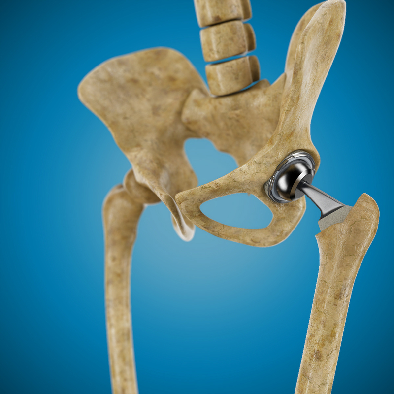 modèle 3D de Prothèse fémorale avec tibia et bassin - TurboSquid 892614