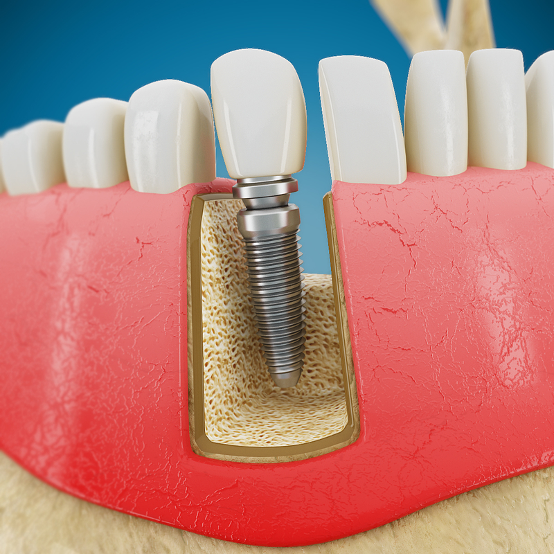 3d dental implant