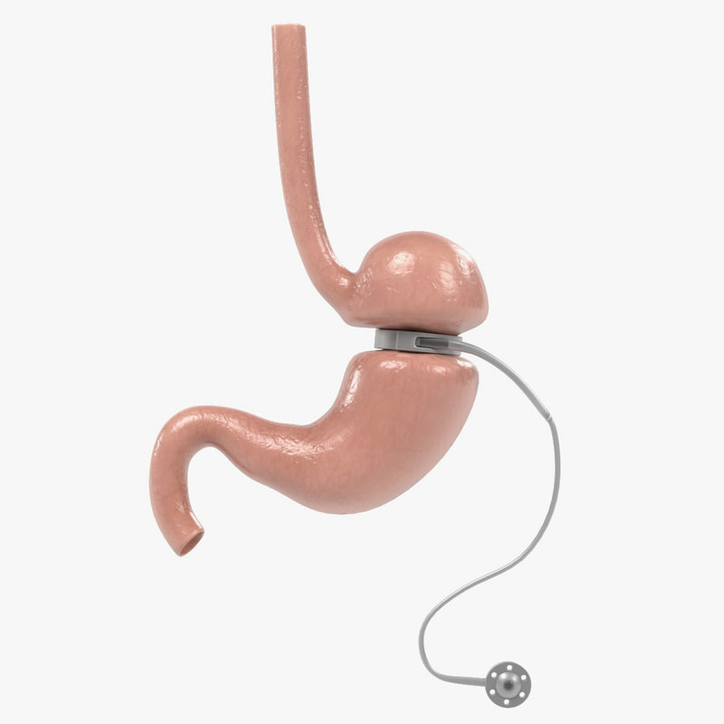 stomach gastric band 3ds