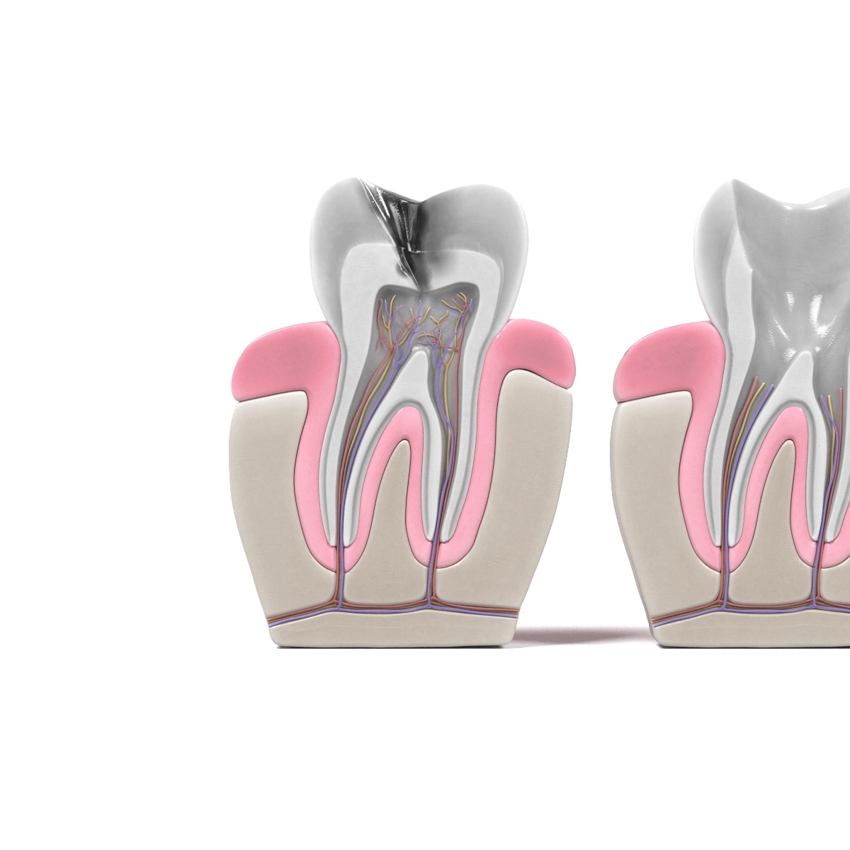 3d root canal procedure 3d root canal procedure