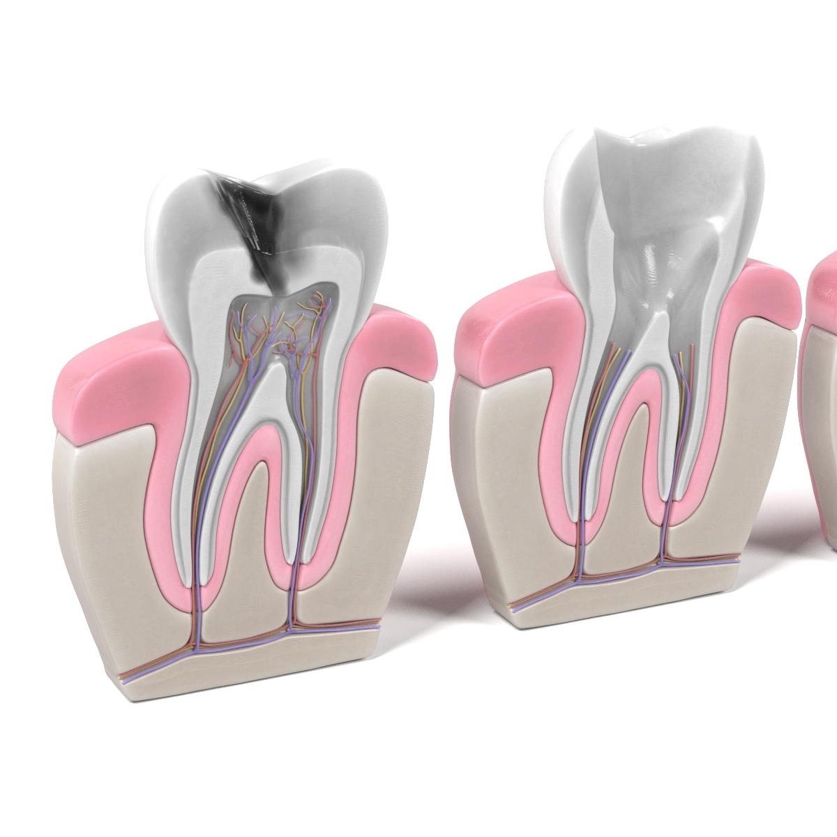 3d root canal procedure