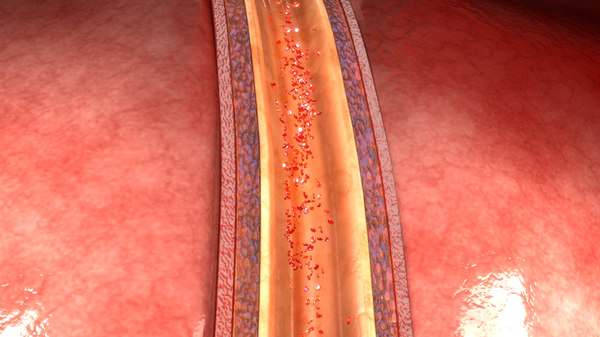 3d artery dissection animation model