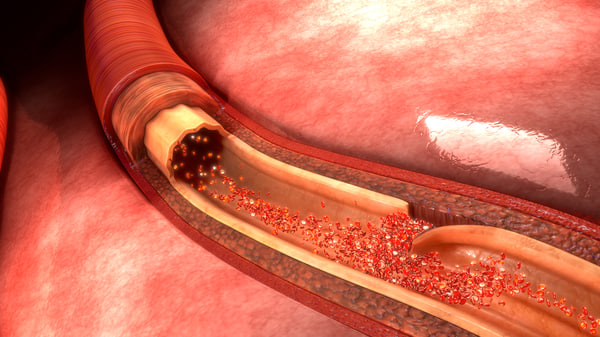 3d artery dissection animation model