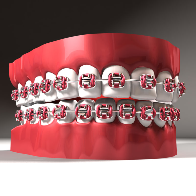 teeth braces 3d model