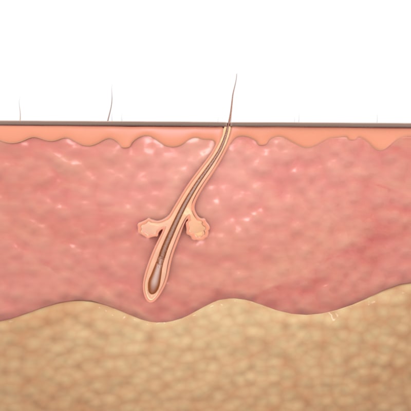 infected acne pore 3d model