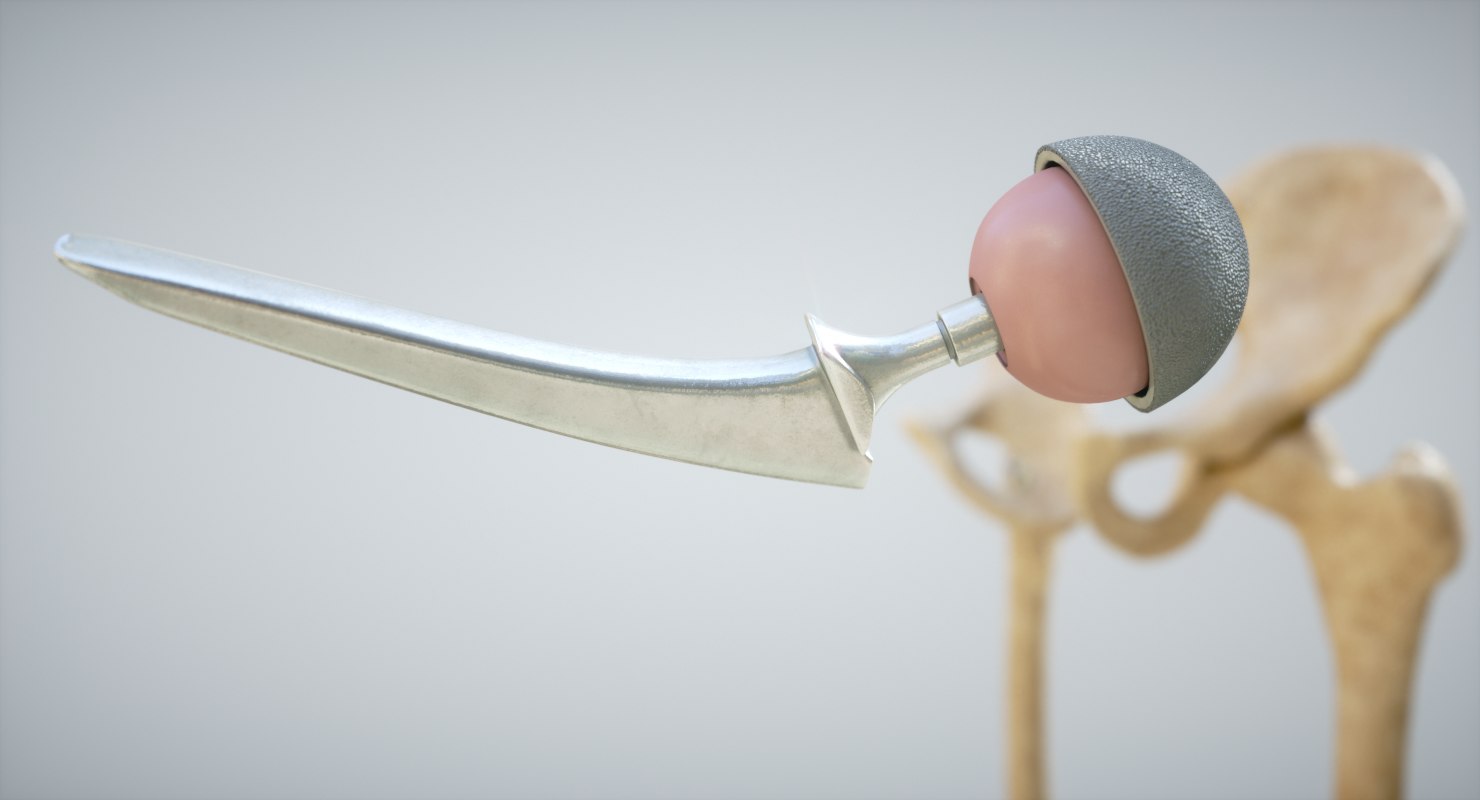 medical endoprosthesis 3d model