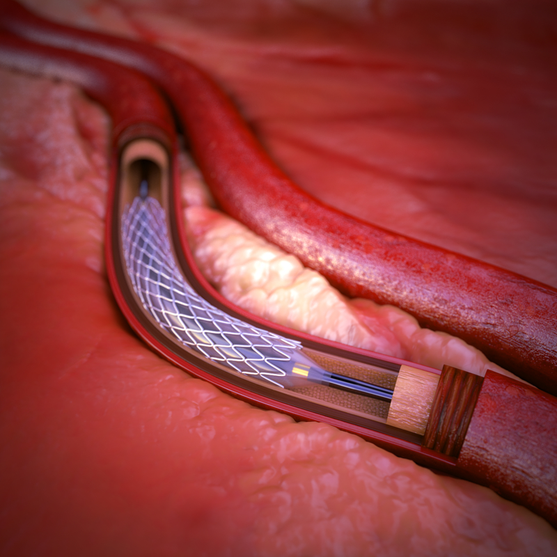 coronary artery stent 3d max