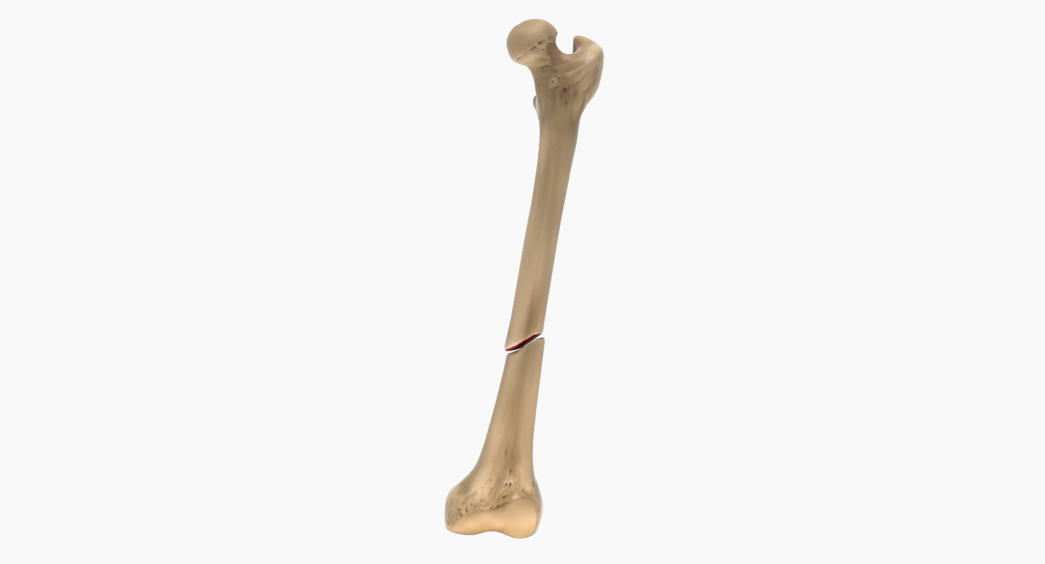3D oblique fracture bone - TurboSquid 1338395