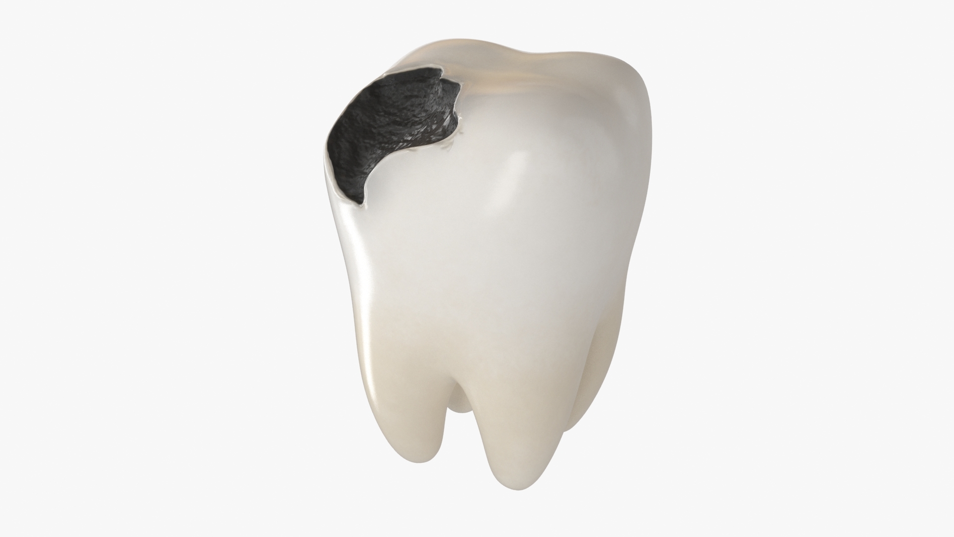 Teeth decay 3D model - TurboSquid 1438129