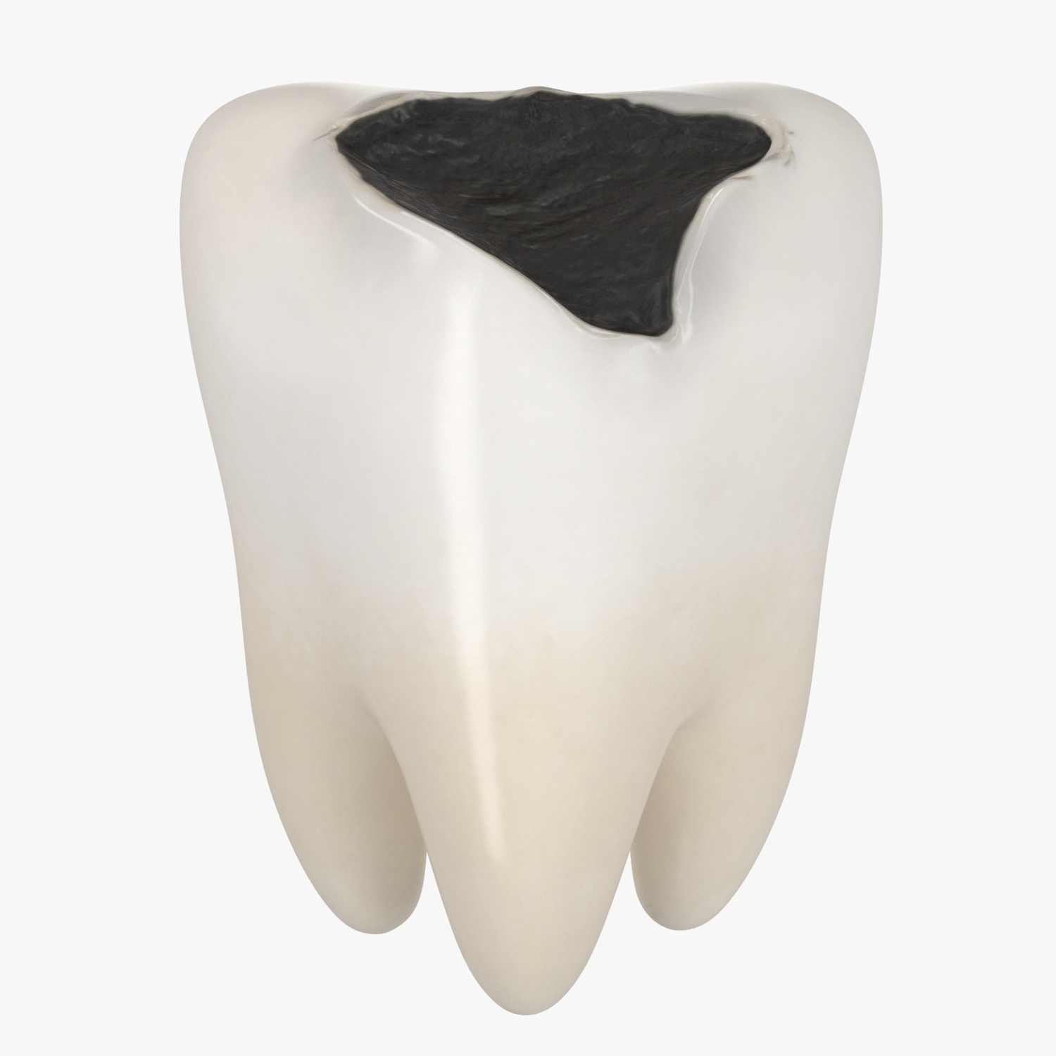 Teeth decay 3D model - TurboSquid 1438129