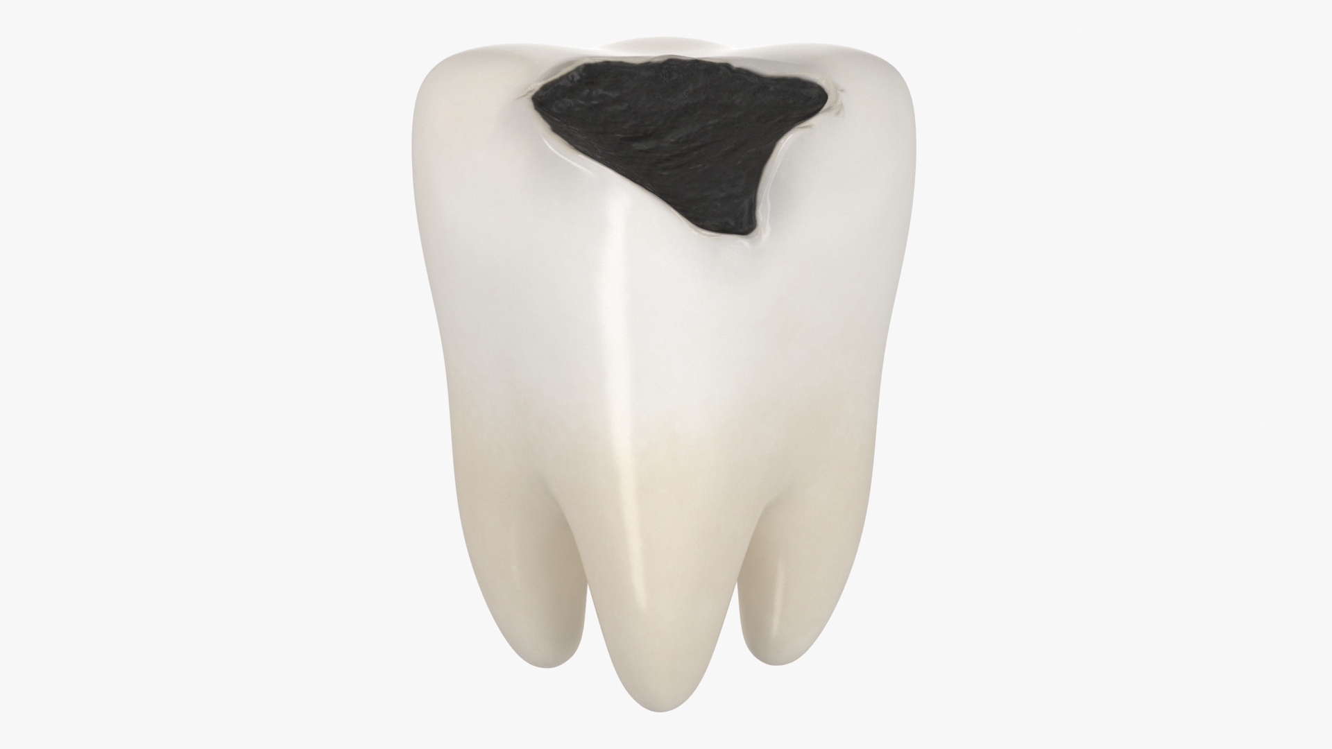 Teeth decay 3D model - TurboSquid 1438129