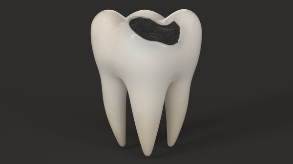 Teeth decay 3D model - TurboSquid 1438132