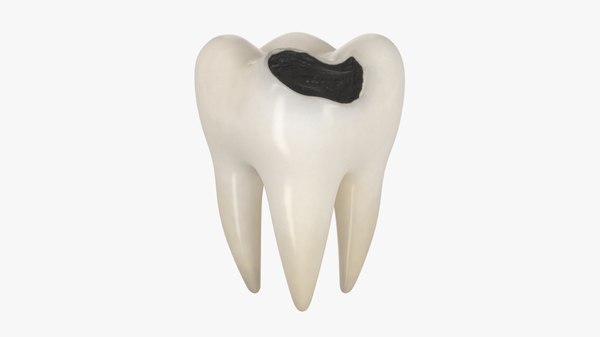 Teeth decay 3D model - TurboSquid 1438132