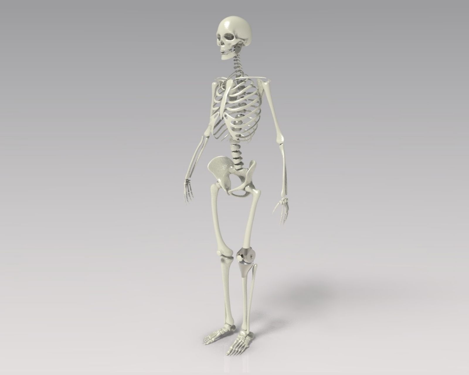 Knee tumor prosthesis 3D - TurboSquid 1464660