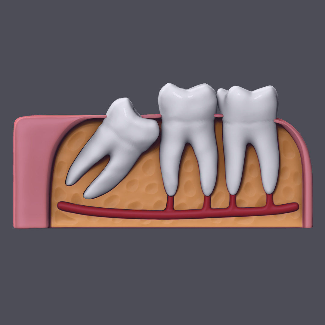 3D wisdom impaction tooth - TurboSquid 1471461