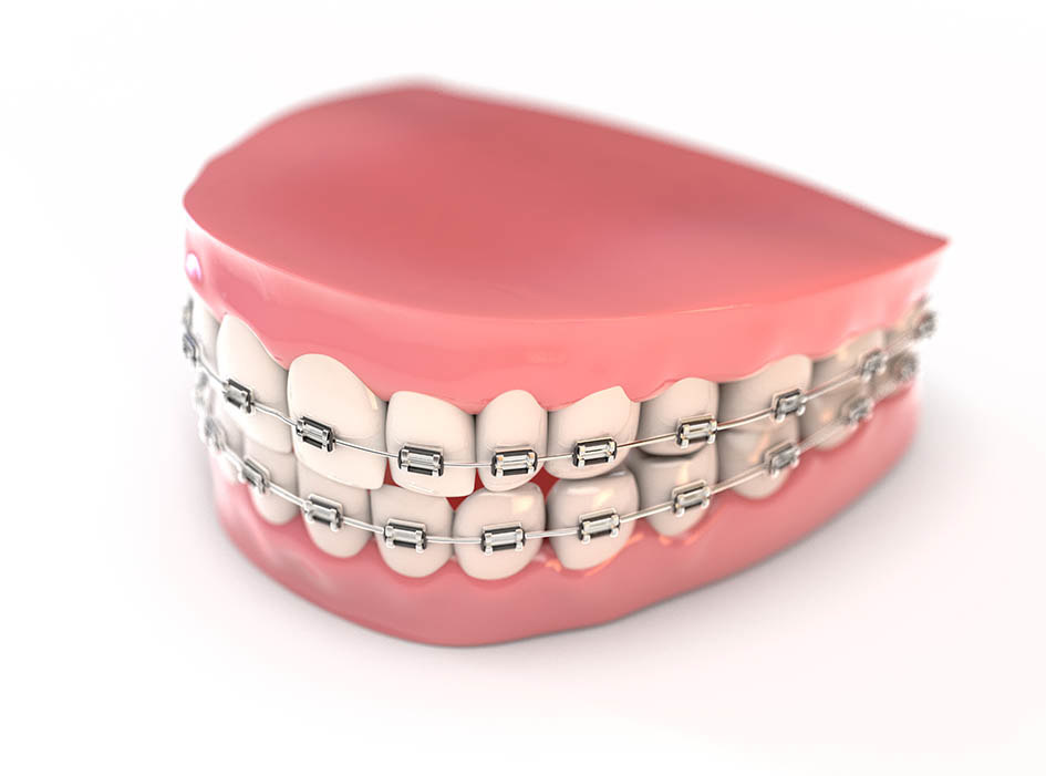 Fake Teeth Braces Model Turbosquid 1471661