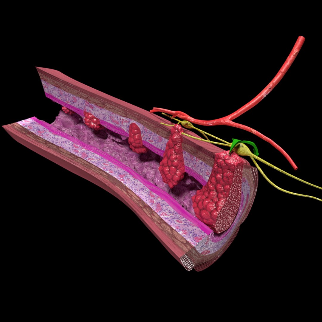 3D colon cancer staging - TurboSquid 1480137