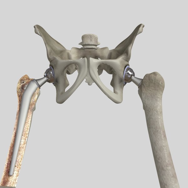 Replacement hip 3D - TurboSquid 1520195