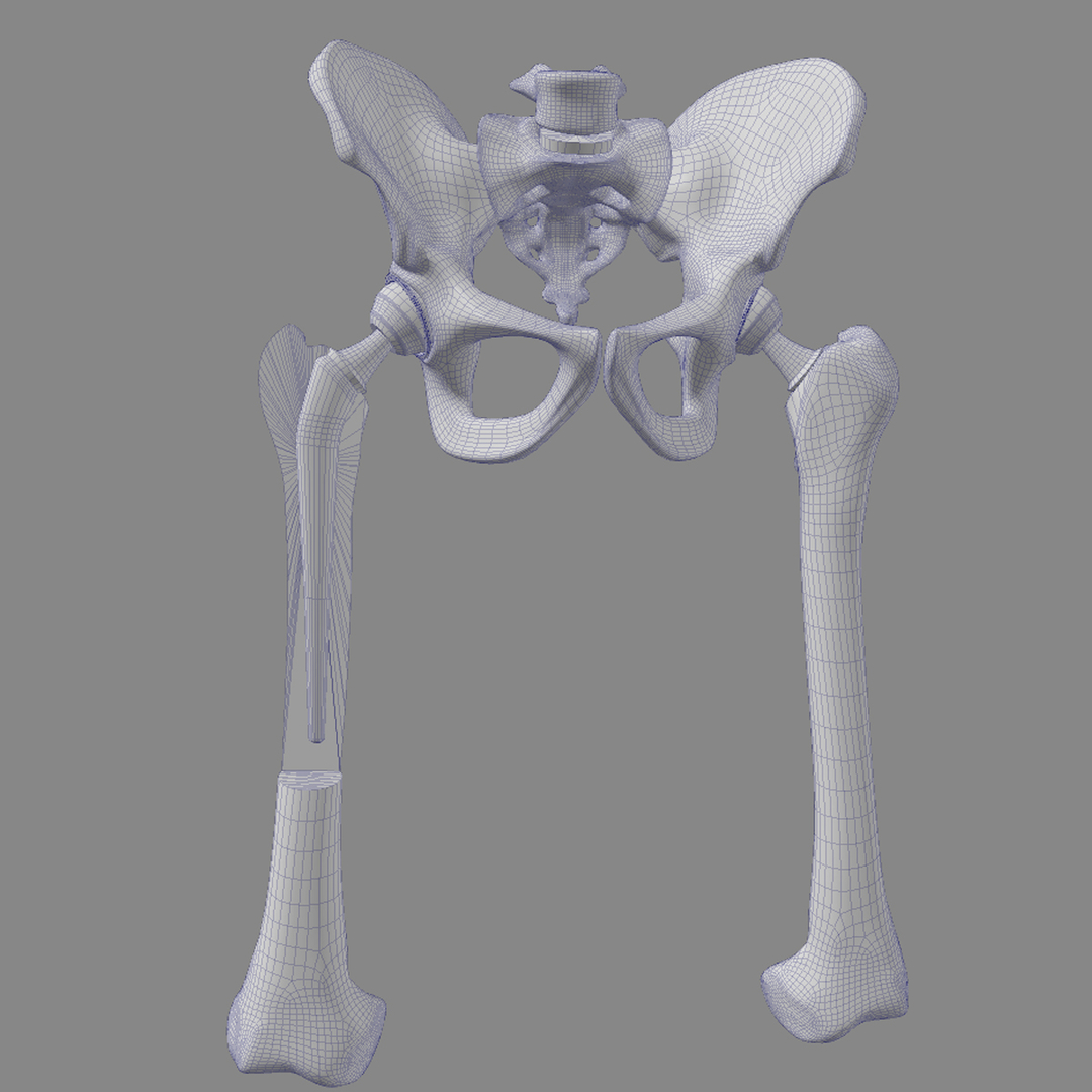 Replacement hip 3D - TurboSquid 1520195