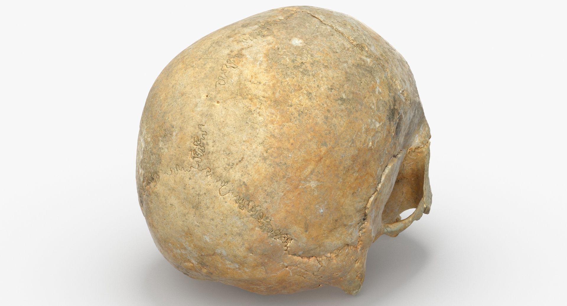 Human skull cranium leprosy 3D model - TurboSquid 1537597